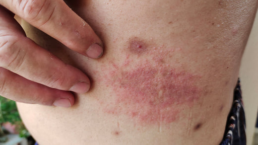 How to Apply Diaper Rash Cream the Right Way – Because